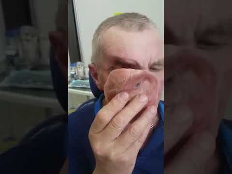 kaza sonucu mıknatıslı göz ve çene