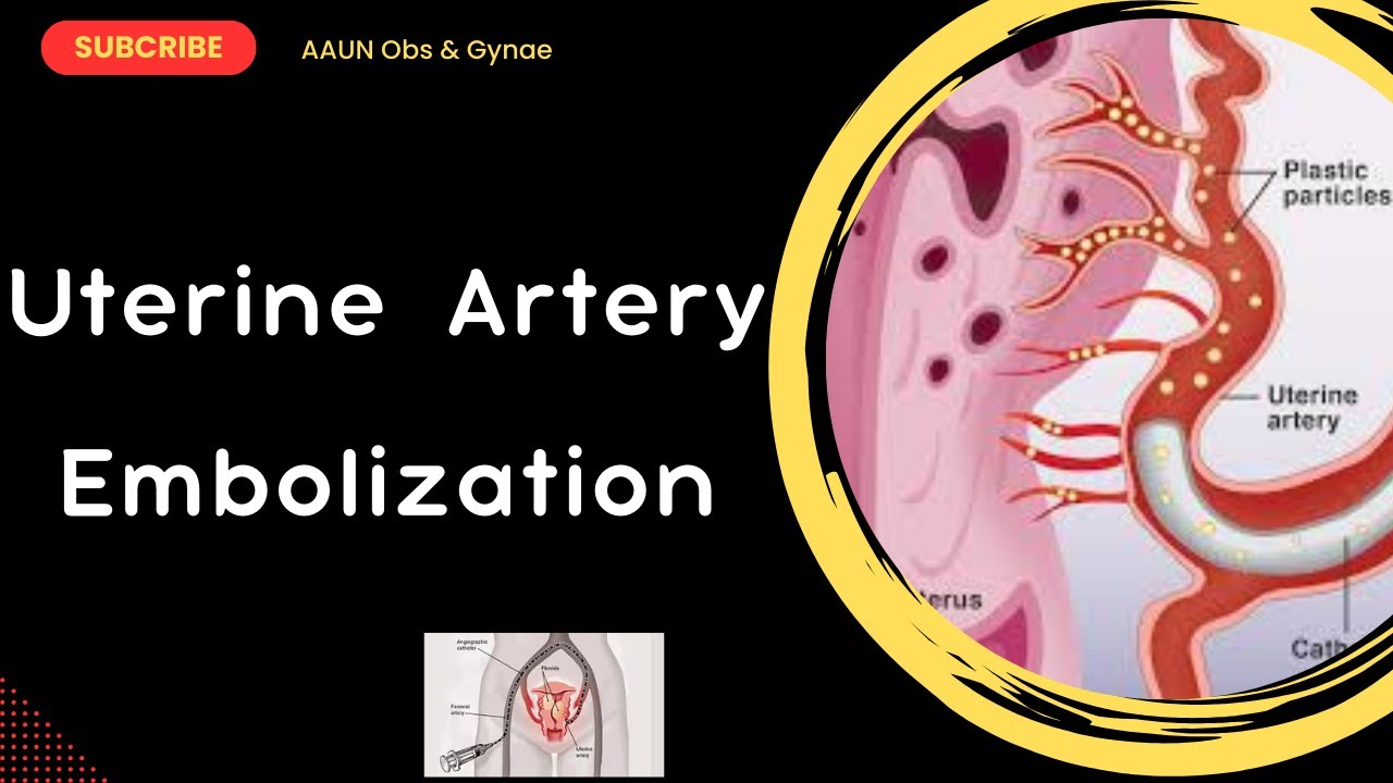 Uterine Artery Embolization: Indications, Procedure, Complications and ...