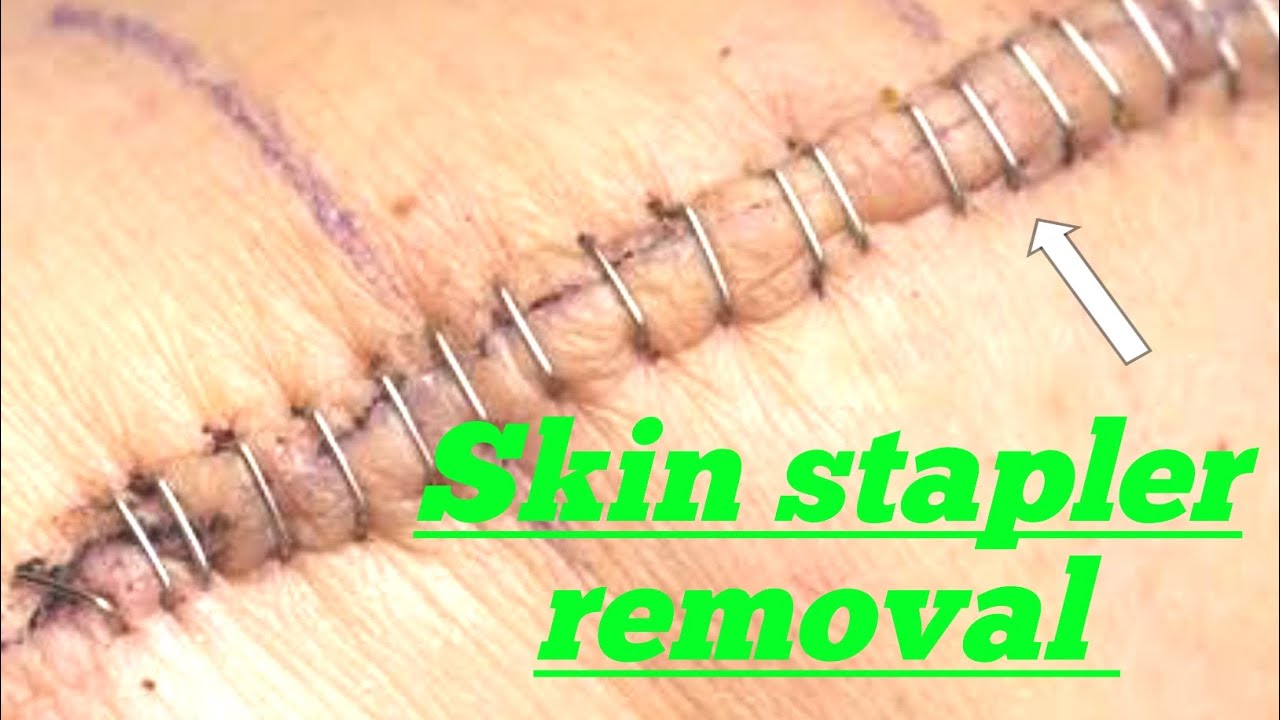 Skin stapler removal Right hip joint 🙏 - YouTube