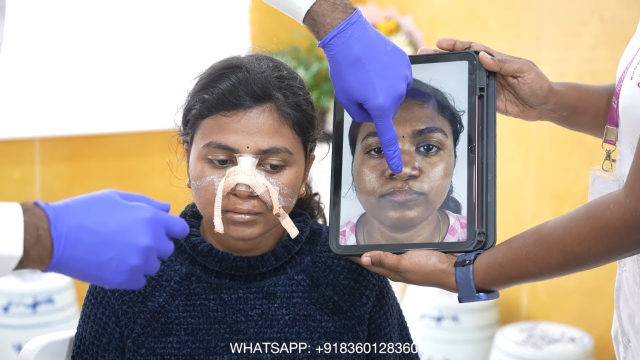 Incredible Cleft Lip & Nose Correction | Patient Makeover - YouTube
