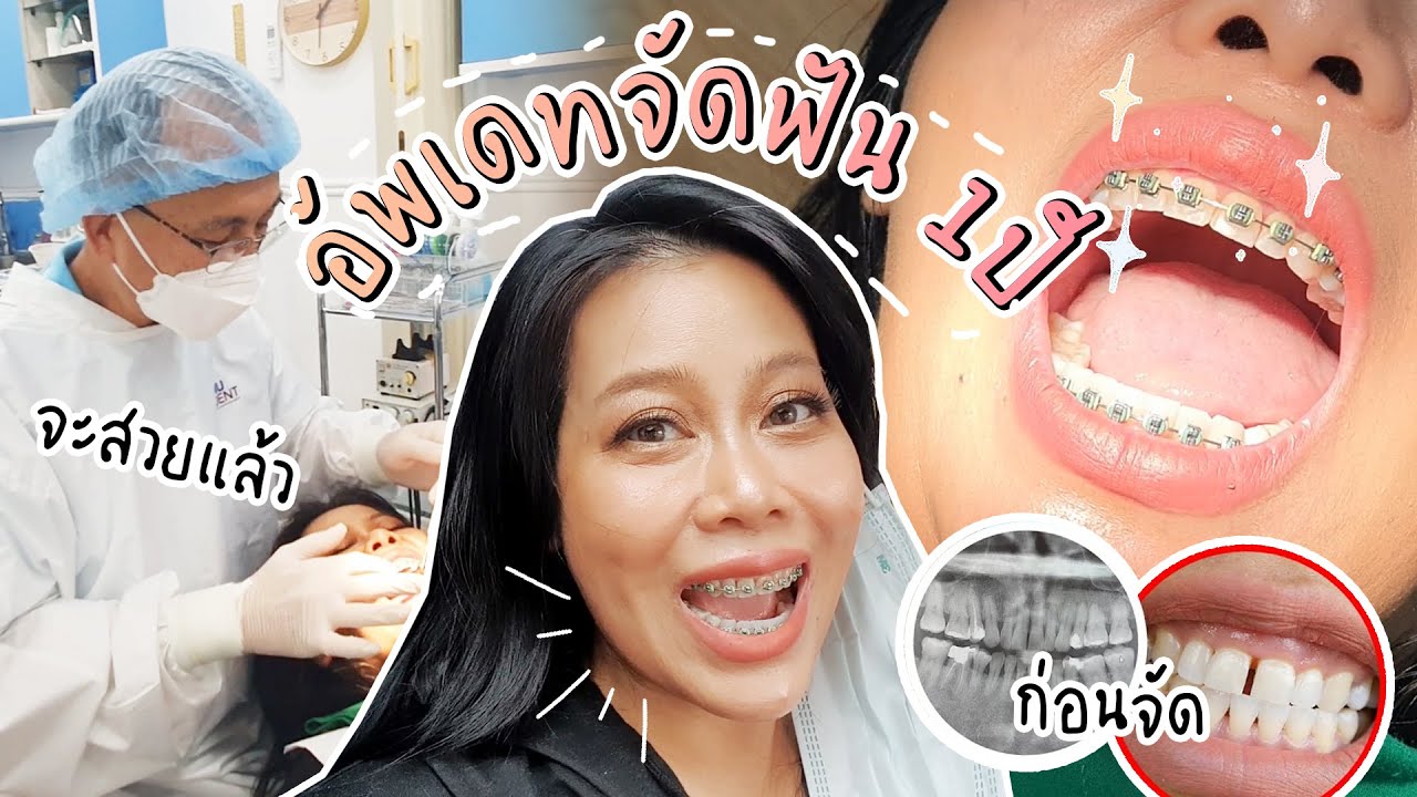 อัพเดท!! จัดฟันแบบ AOSC 1 ปีเต็มๆ เพราะรากฟันอักเสบ ฟันห่าง ไม่สบ ...