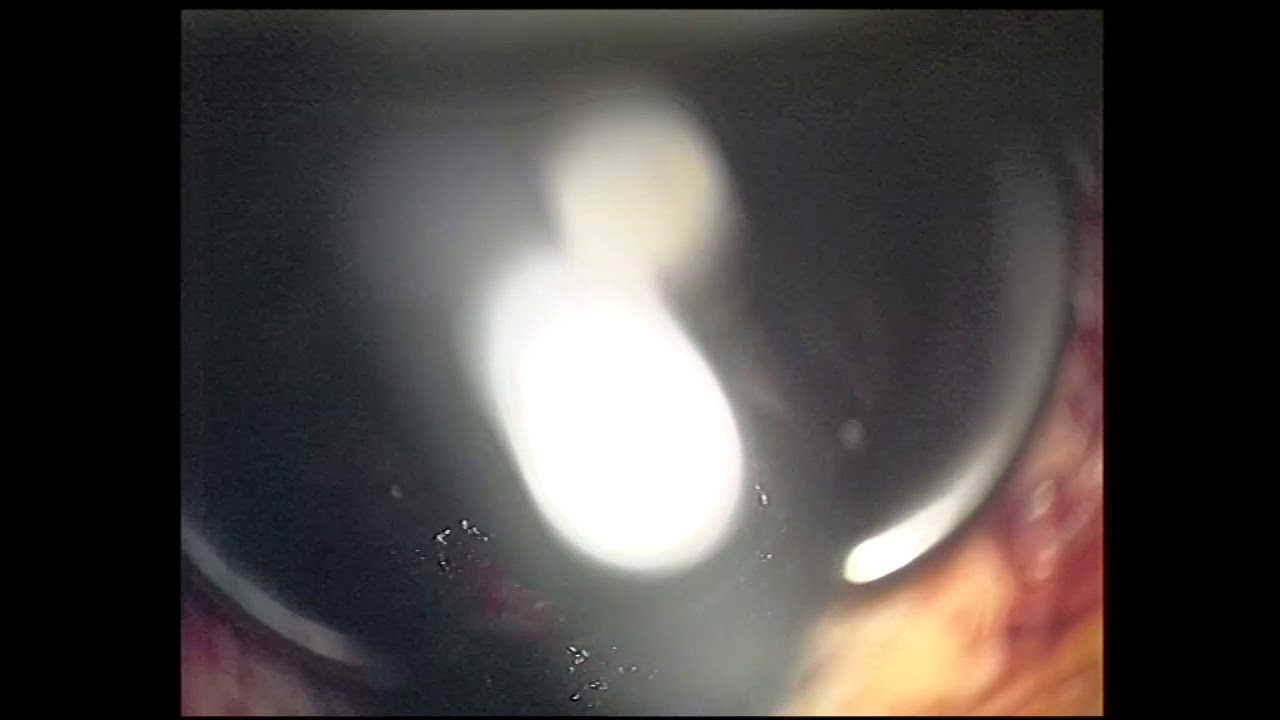 Hernia disco lumbar Doctor Bernardo Mosqueira - YouTube