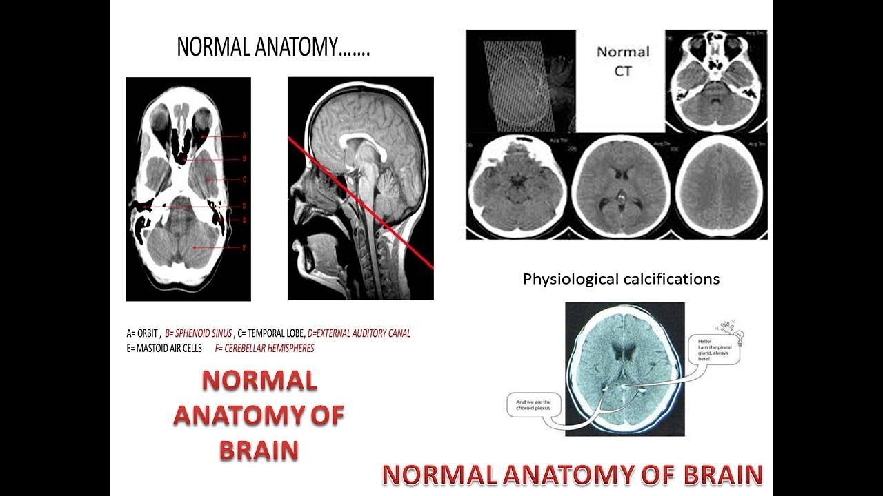 how to read Ct scan of Brain |Anatomy of Brain - YouTube