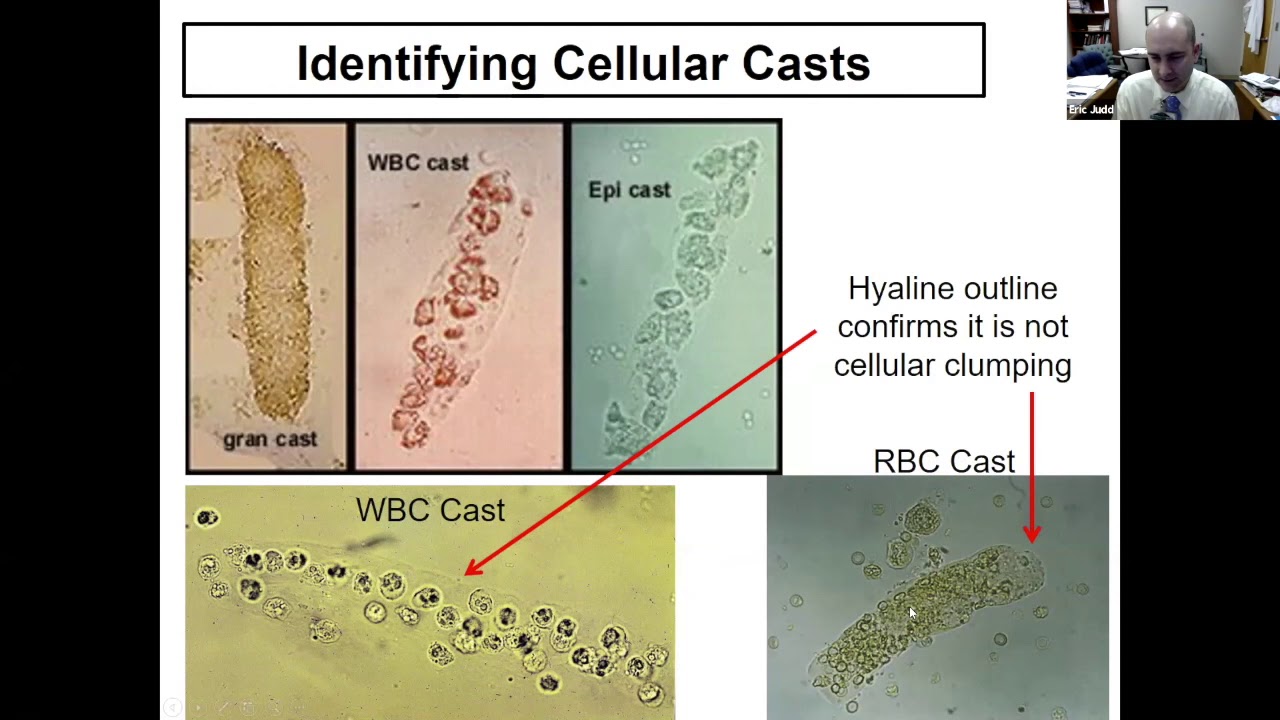 Cellular Cast In Urine