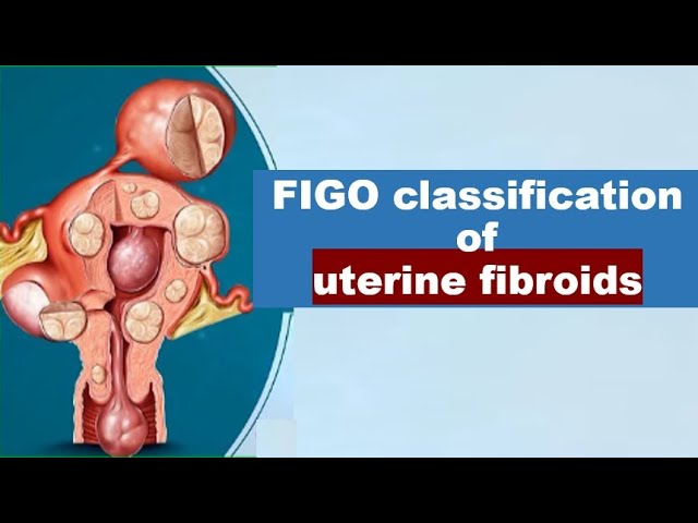 Fibroid Classification Figo