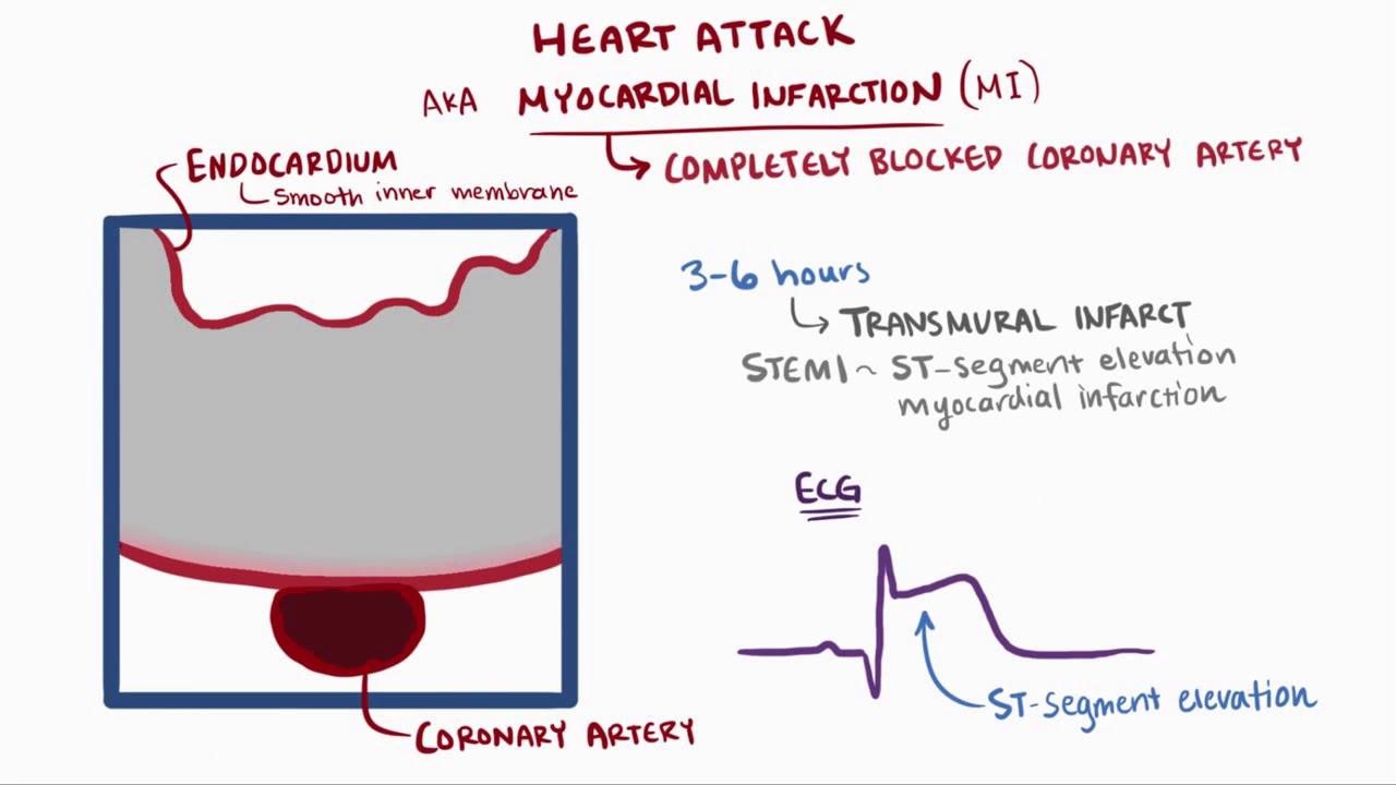 Đau tim Heart attack acute myocardial infarction causes, symptoms ...