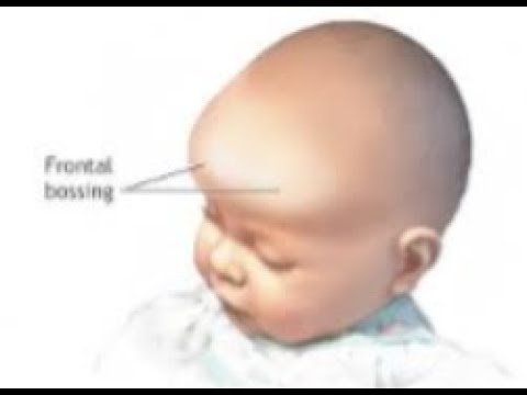 Frontal Bossing Or Skull Bossing Or abnormal prominence of the forehead ...