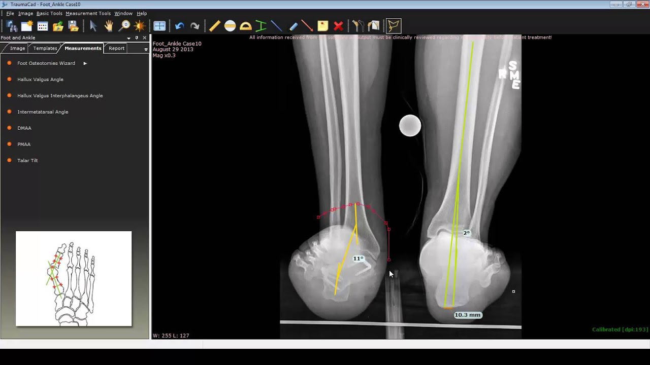 Foot and Ankle Deformity Correction with Dr. Noman Siddiqui - Hindfoot ...
