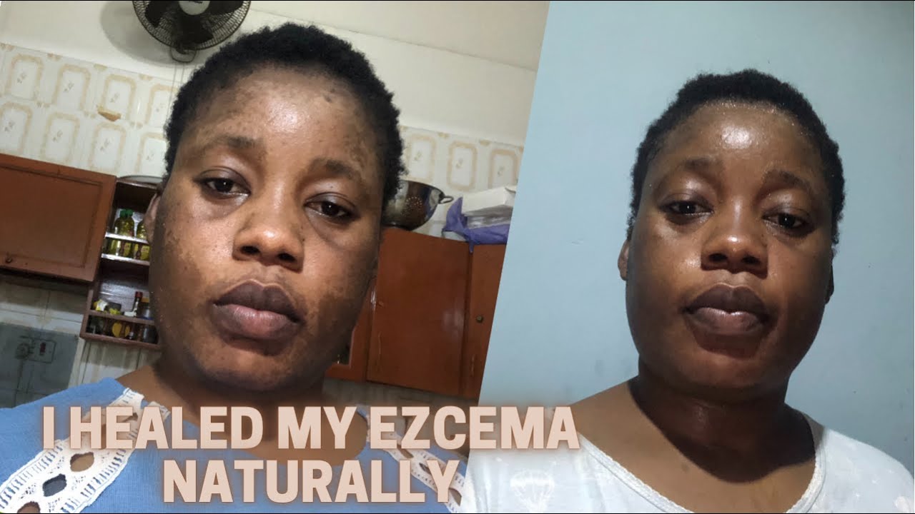 How i HEALED MY ECZEMA QUICKLY/Natural and REALISTIC way to clear ...