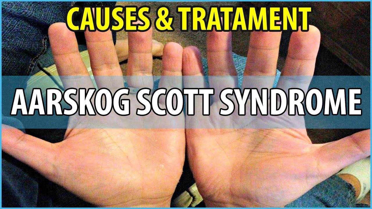 What is Aarskog Scott Syndrome, Causes, Symptoms and Treatments - YouTube