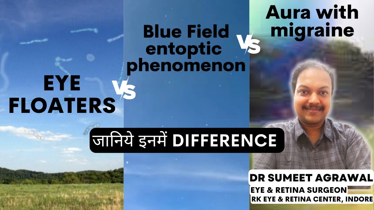 यह चीज़ें eye floaters जैसी दिखती हैं पर होती नहीं l Blue field ...