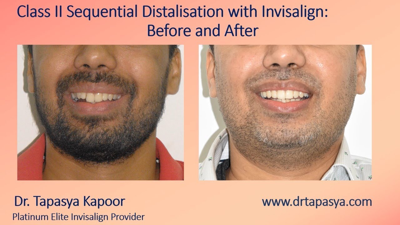 Invisalign Treatment: Class II Correction with Sequential Distalisation ...