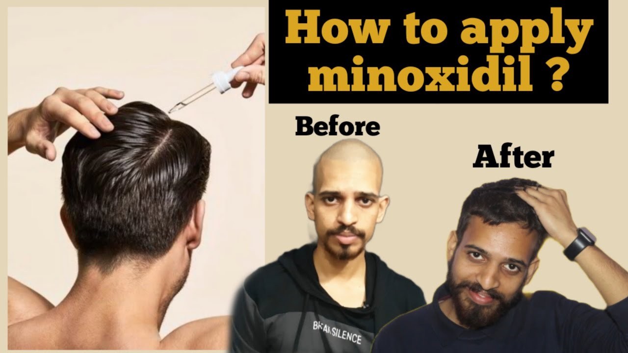 How to apply Minoxidil for hair regrowth || How to use Minoxidil ...