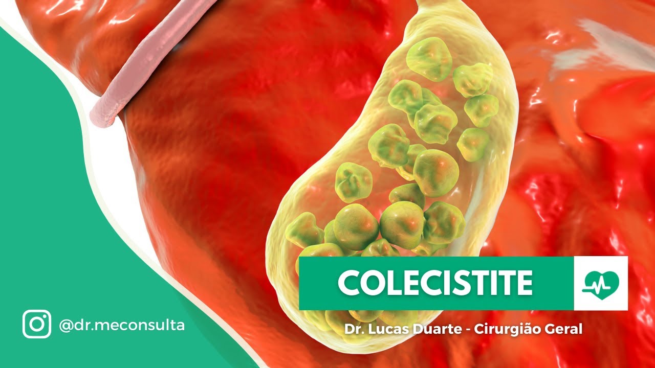 Colecistite: O que é? - YouTube