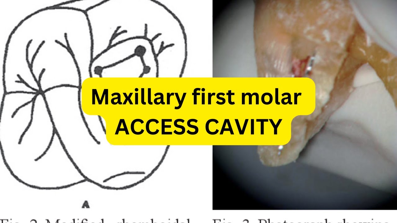 MAXILLARY FIRST MOLAR ACCESS CAVITY - YouTube