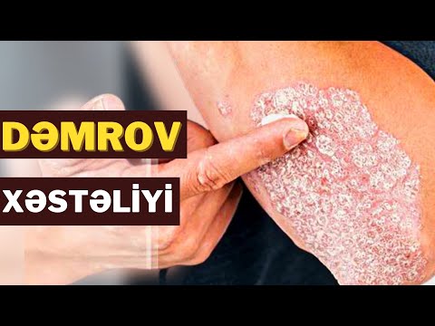 Yayılmış Dəri Xəstəliyi DƏMROV ! - Tam Müalicə Olunurmu?