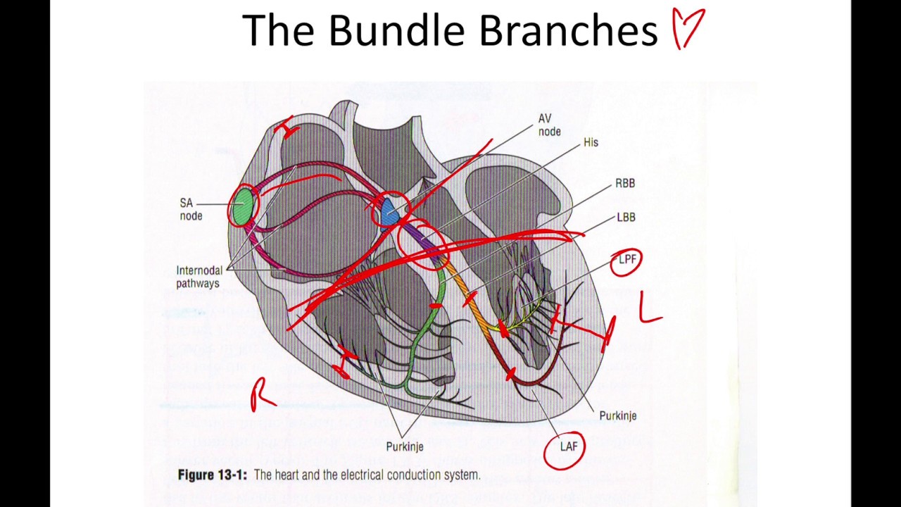 12-Lead EKG, Part 6: Wide QRS. Right vs. Left Bundle Branch Block - YouTube