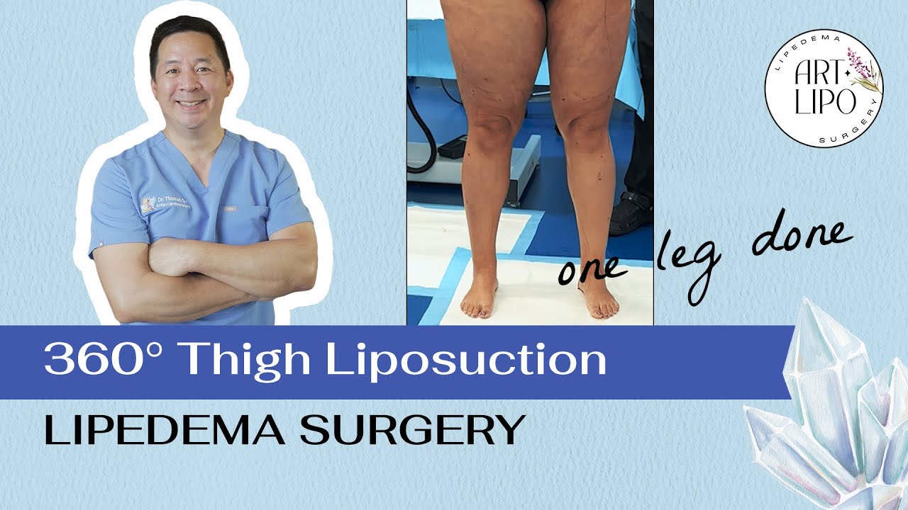Lipo 360° Thighs | Leg Liposuction | Lipedema Surgery |Artlipo | Expert Dr. Su - YouTube
