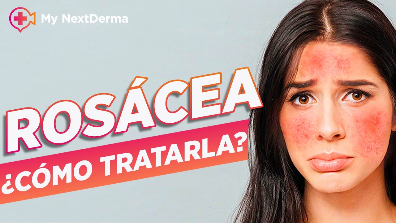 ¿CARA ROJA? Seguro tienes Rosácea / Dermatólogo respode - YouTube