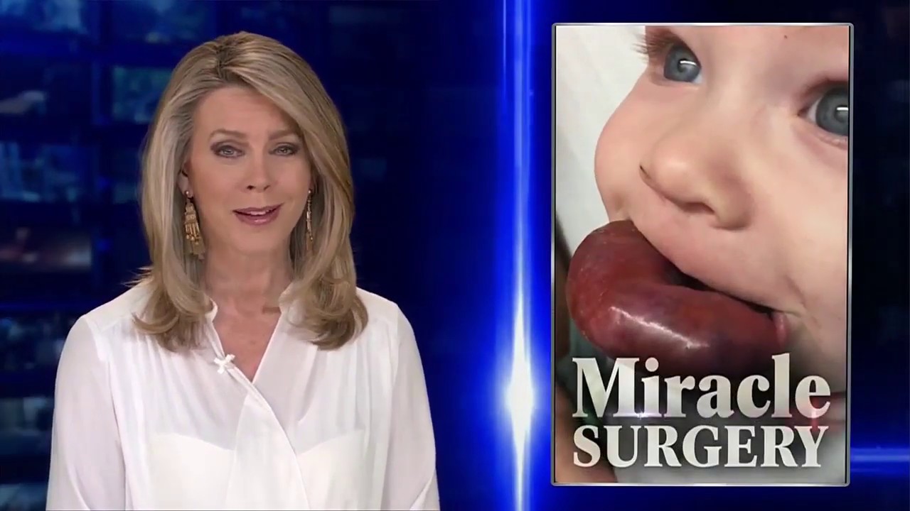 Lip Balloon Surgery | Vascular Surgeon Dr Milton Waner New York, NY ...