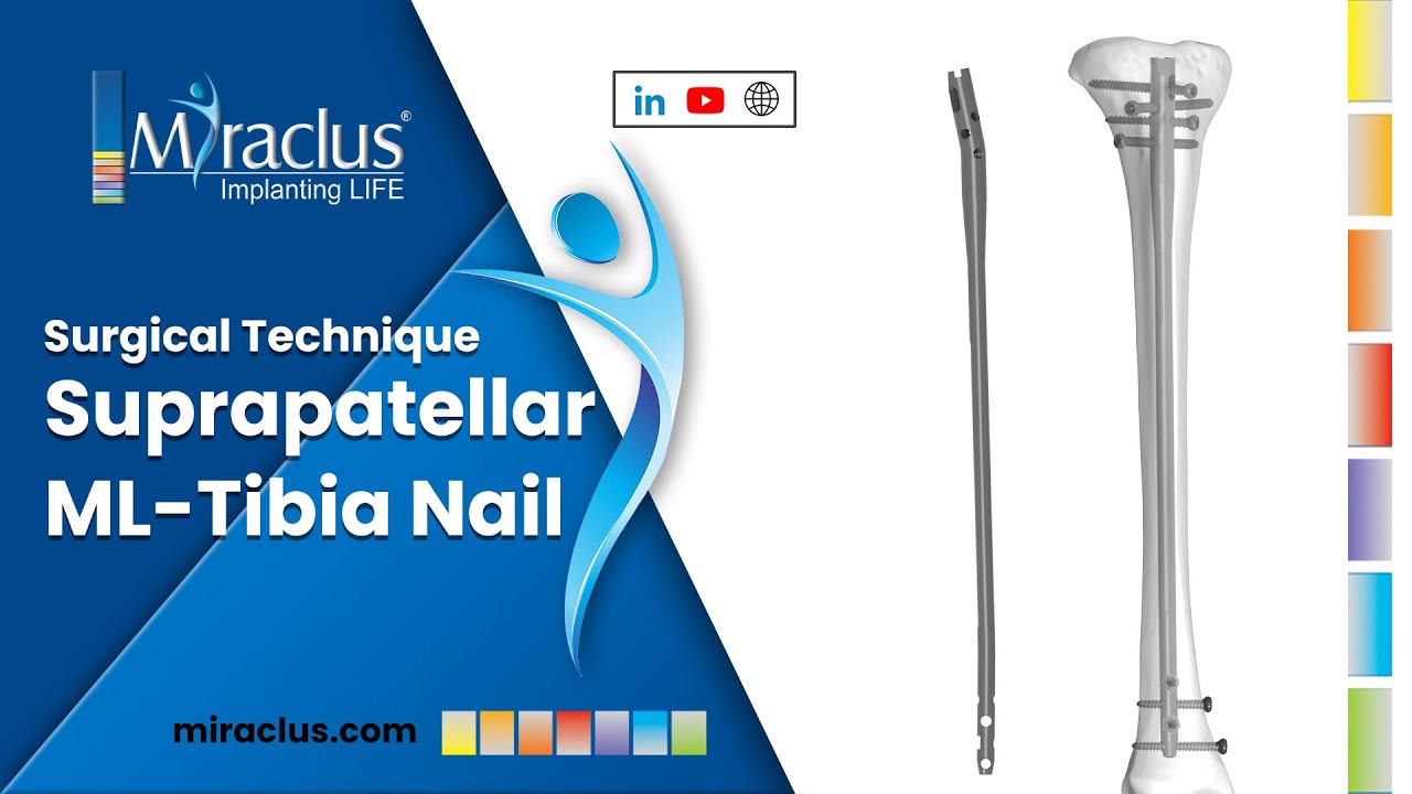 Suprapatellar ML Tibia Nail Surgical Technique - YouTube