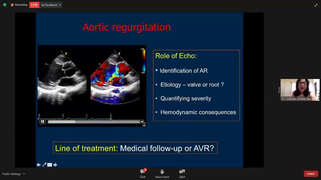 Aortic Regurgitation (Echo Evaluation) - YouTube