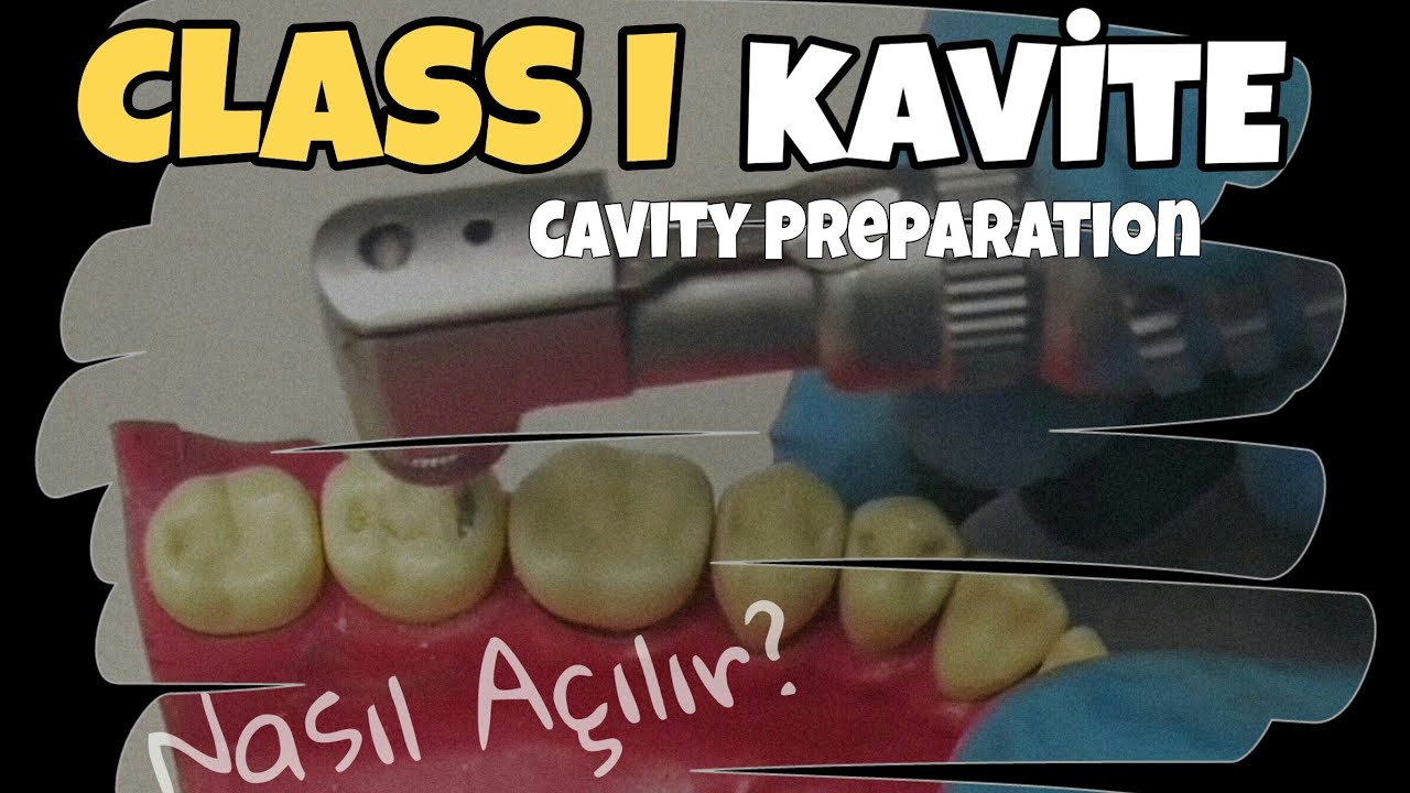 CLASS I KAVİTE - Cavity Preparation (Kavite nasıl açılır?) - YouTube