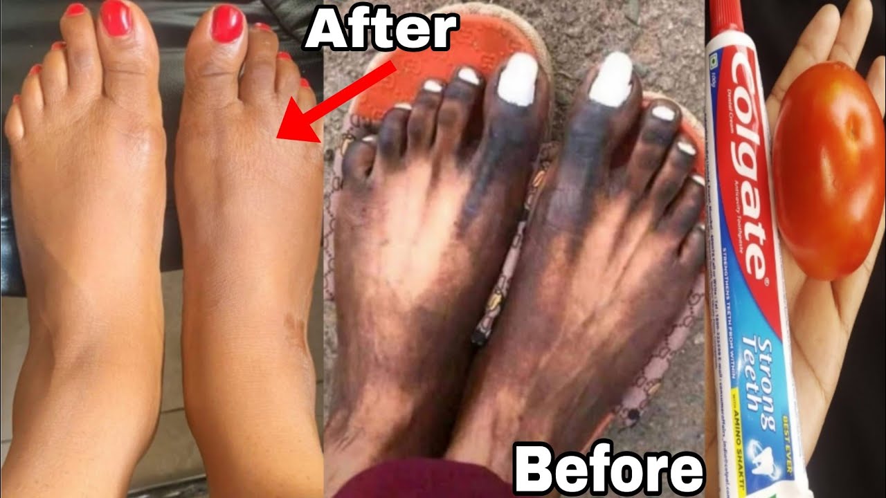 I Cleared My Leg Wrinkles| Get clear brighter smooth younger looking ...