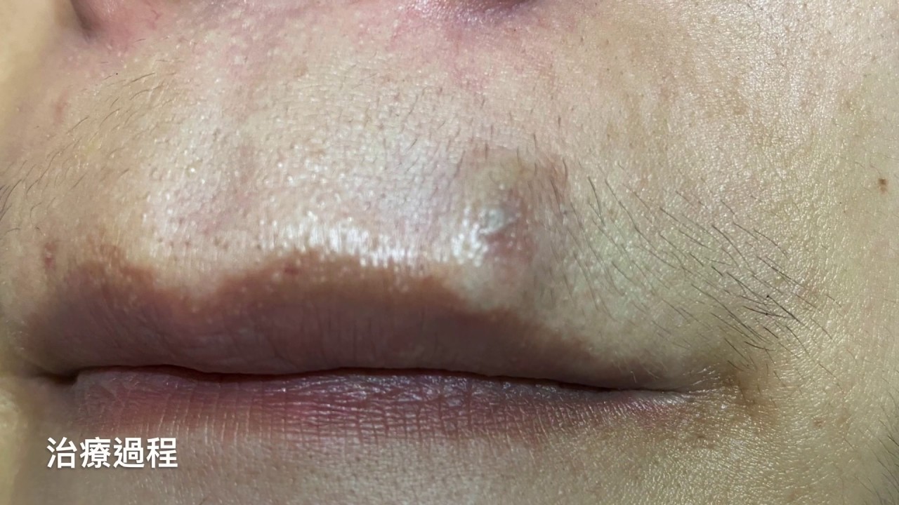 臉部人中嘴唇粉瘤切除 美麗新城診所莊禮謙醫師 Epidermal Cyst, philtrum, face, Minimal Incision ...