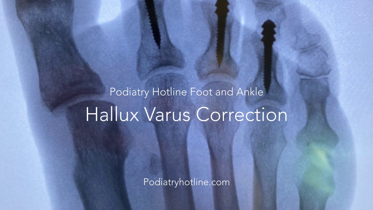 Hallux Varus Correction- Podiatry Hotline Foot and Ankle - YouTube