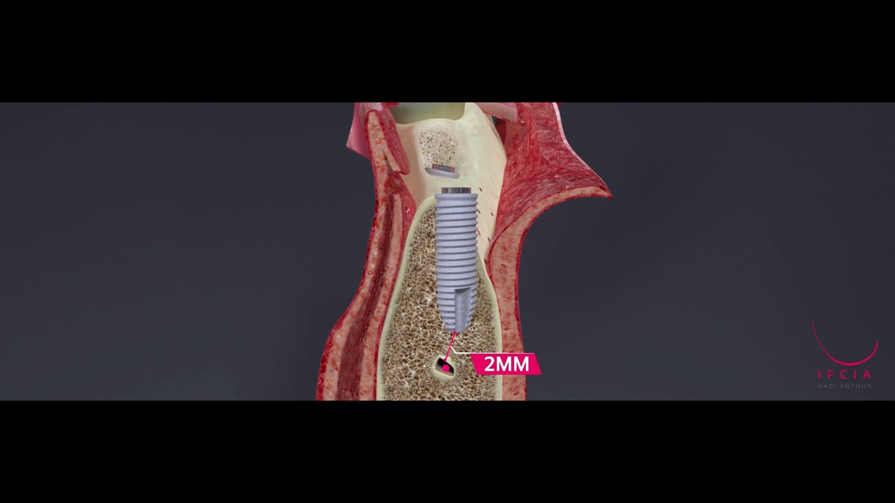 Horizontal Bone Augmentation with GBR Dr. Hadi Antoun - YouTube