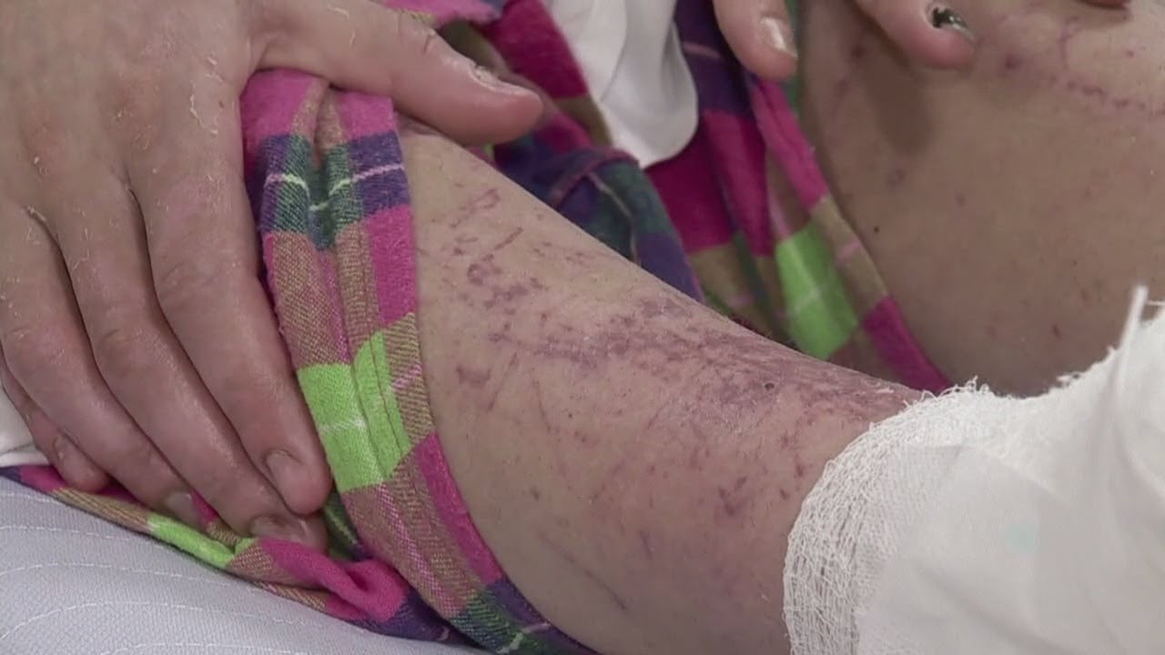 Woman treated for hypothermia & frostbite - YouTube