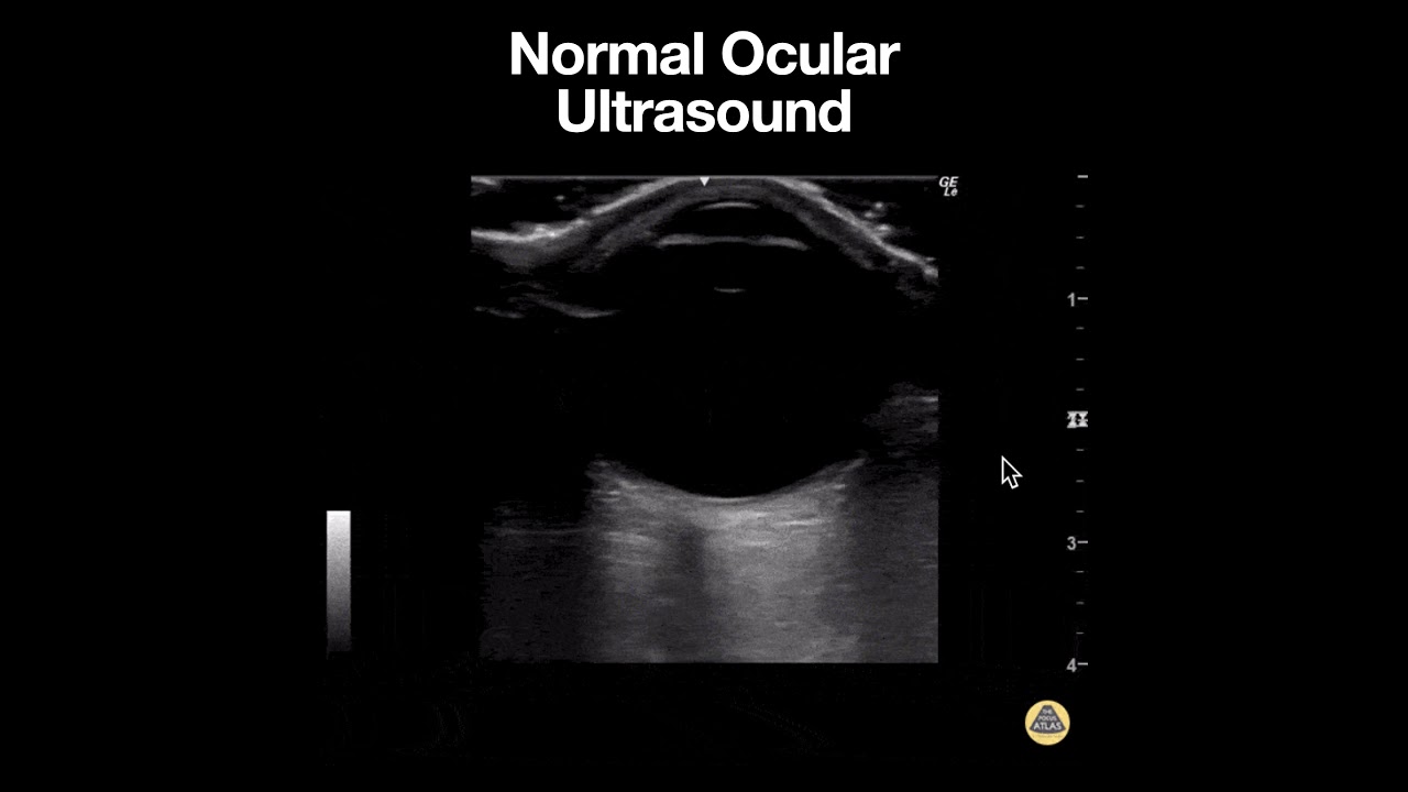 Normal Ocular Ultrasound Anatomy - YouTube