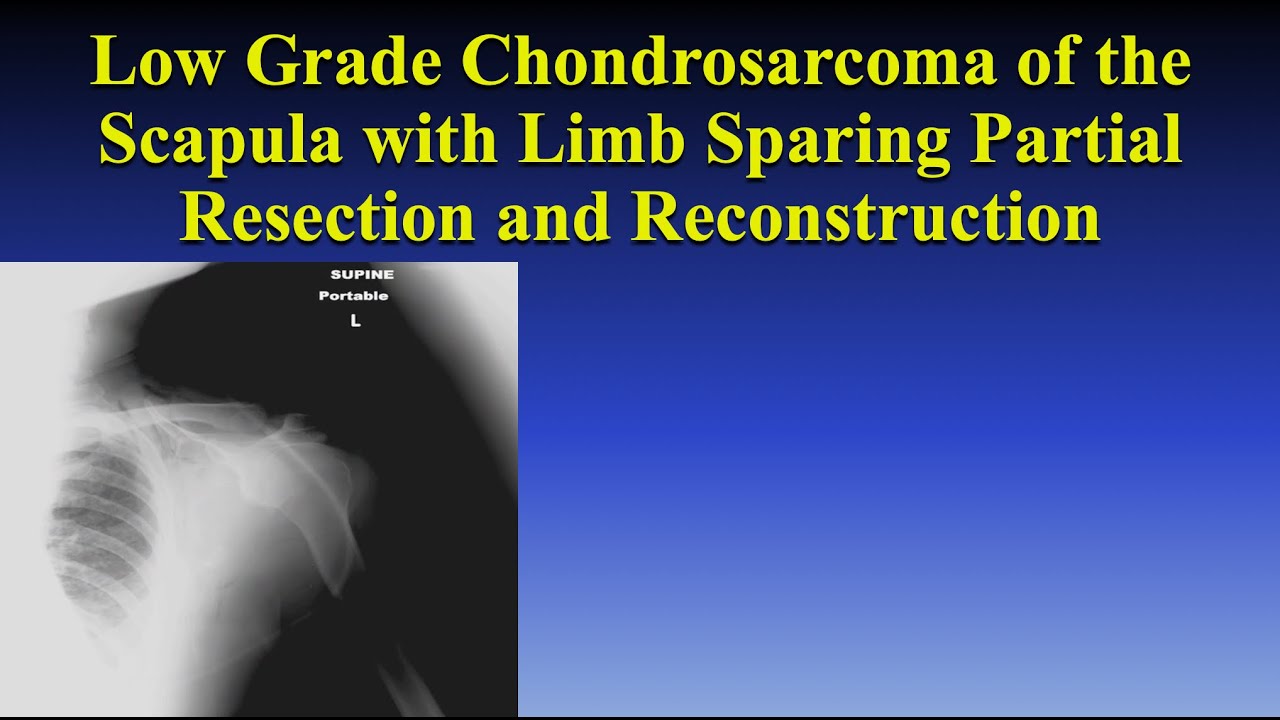 Low Grade Chondrosarcoma of the Scapula Limb Sparing Partial Resection ...