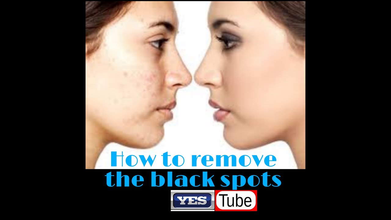 How to remove the black spots on your face - YouTube