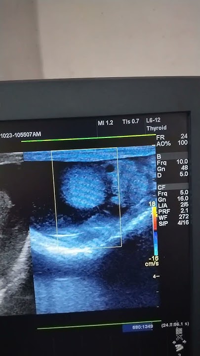 Epididymal Cyst With Testicular Appendix And Hydrocele Ultrasound