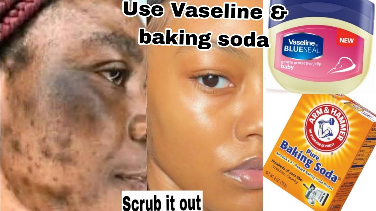 BAKING SODA AND VASELINE CAN TRANSFORM YOUR SKIN FROM DULL TO SPOTLESS ...