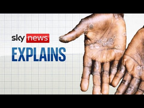 monkey pox Mpox monkeypox disease monkeypox symptoms monkeypox history ...