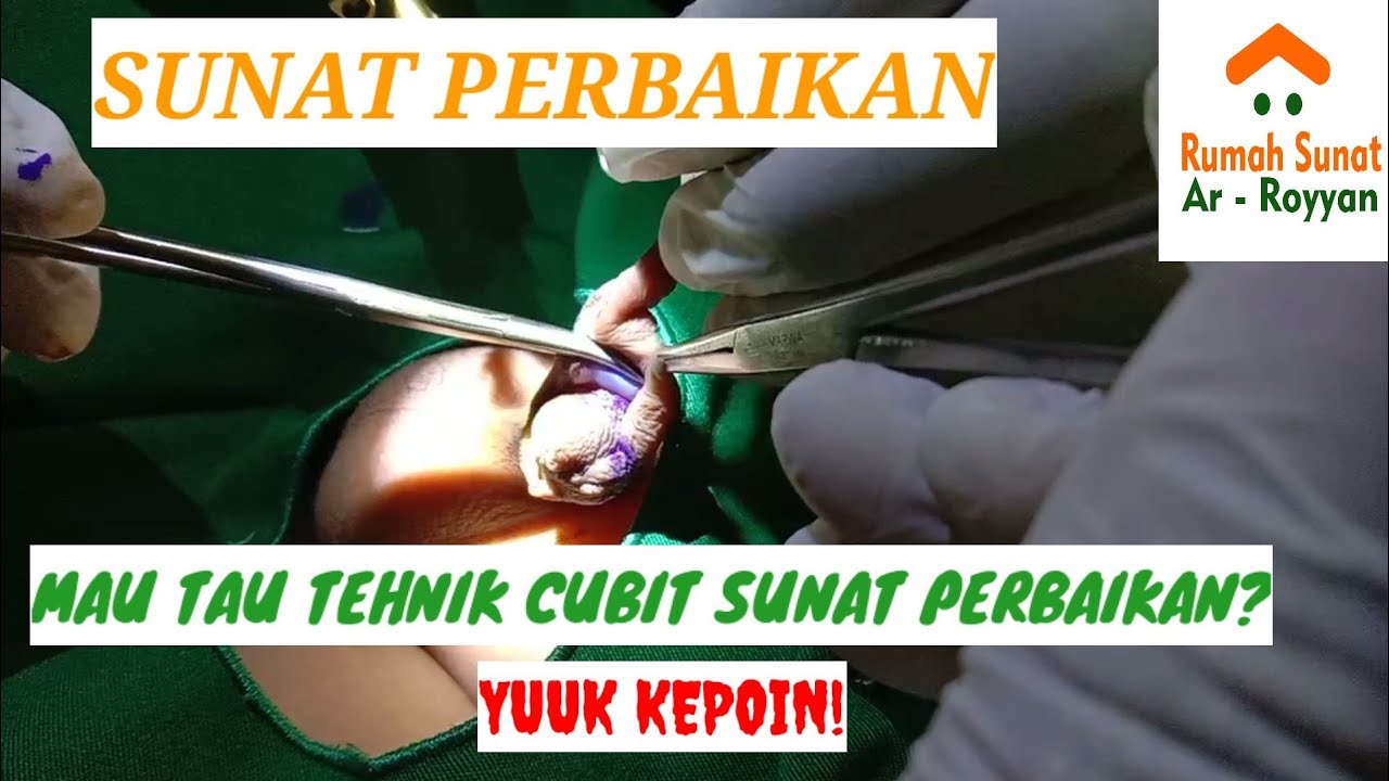 Sunat Perbaikan Combo Sealer || Rumah Sunat Ar-Royyan - YouTube