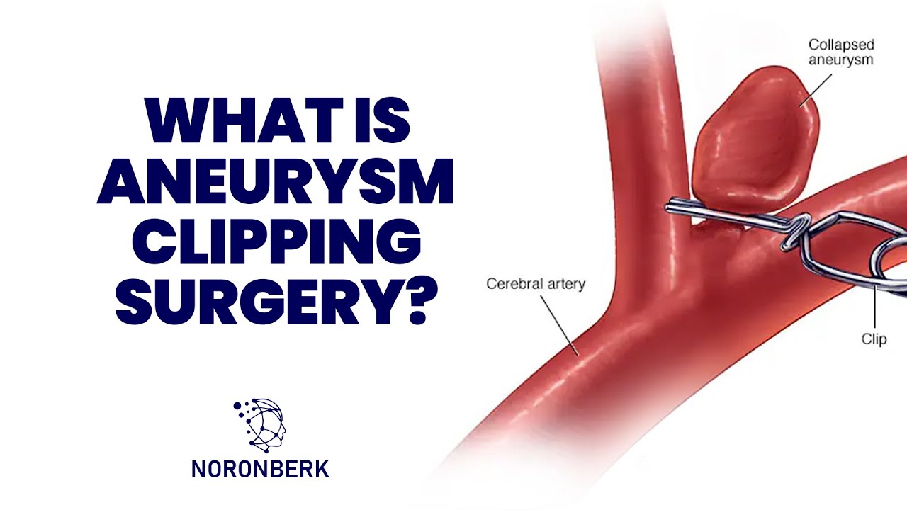 What is Aneurysm Clipping Surgery? - YouTube