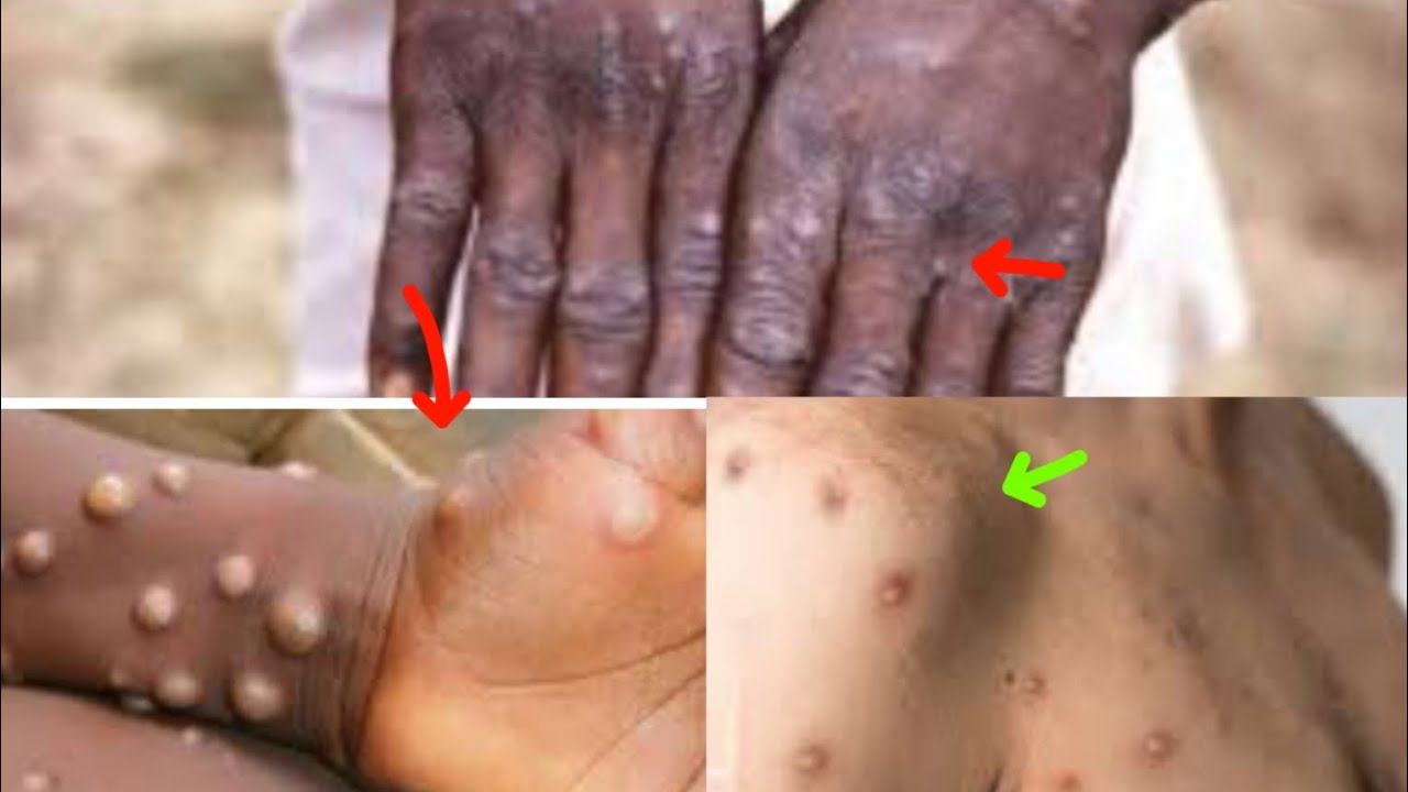 Reba uburyo wakirinda kwandura ikicyorezo r1 keka gusomana reka ...