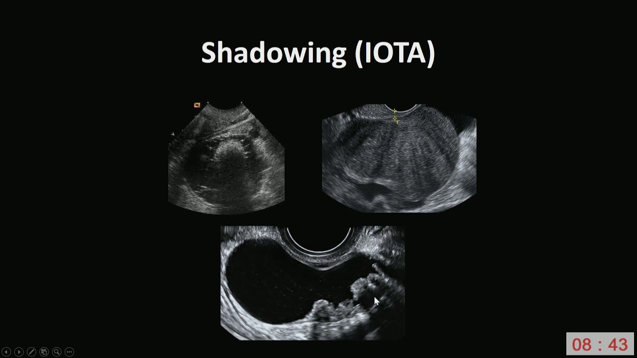 How to describe an adnexal mass IOTA terms and definitions ISUOG 2018 ...