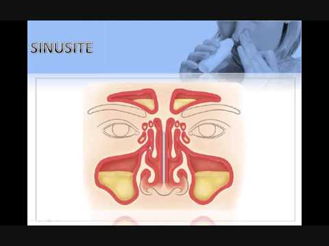 Aula sobre SINUSITES - Parte 3/5 - YouTube