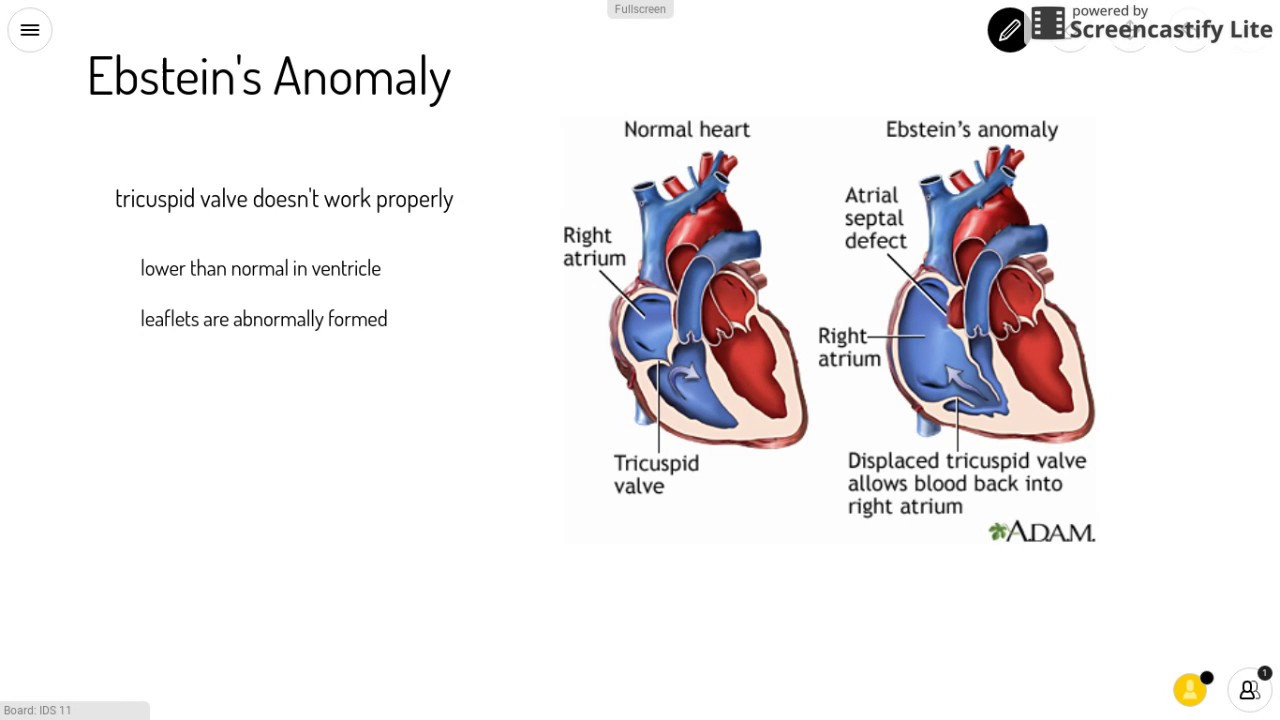 Ebstein Abnormality