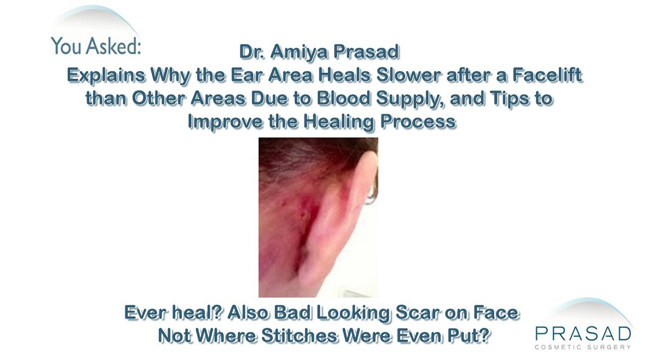 Why The Ears Heal Slowly After A Facelift And How To Improve Healing In why-the-ears-heal-slowly-after-a-facelift-and-how-to-improve-healing-in