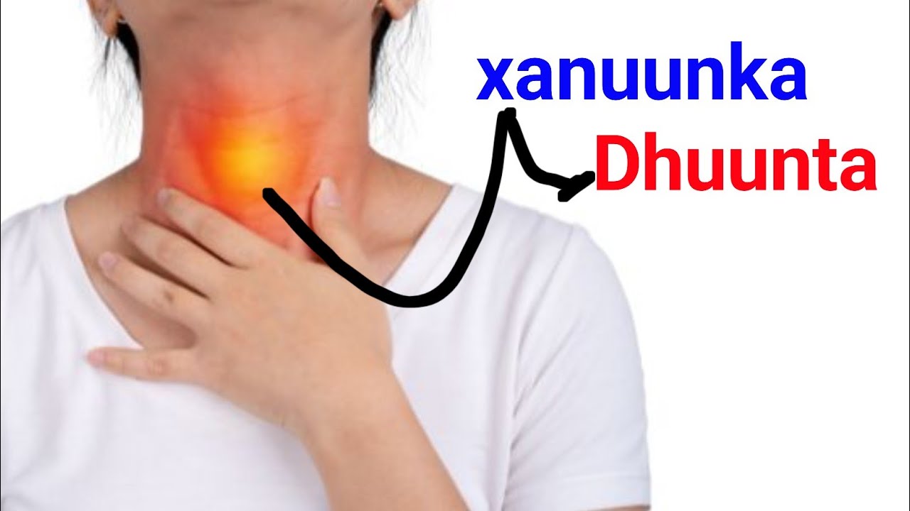 xanuunka Dhuunta maxaa sababo ? - YouTube