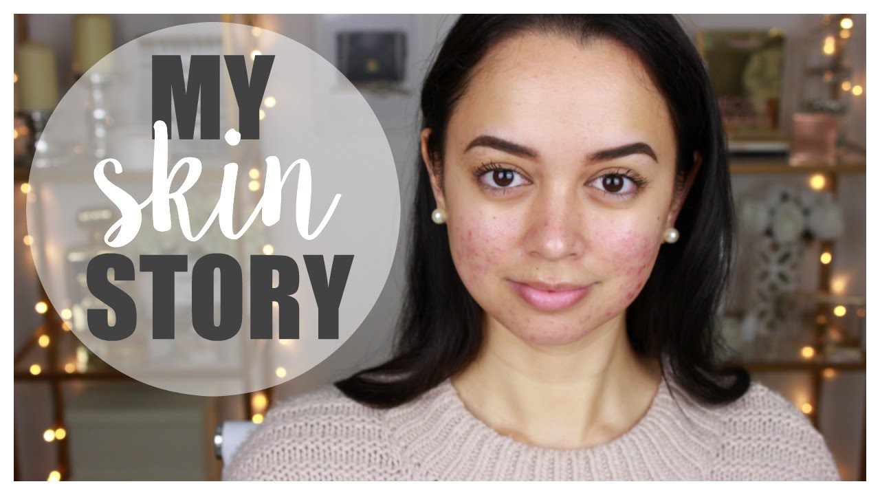 MY SKIN STORY | What Happened to My Face... - YouTube