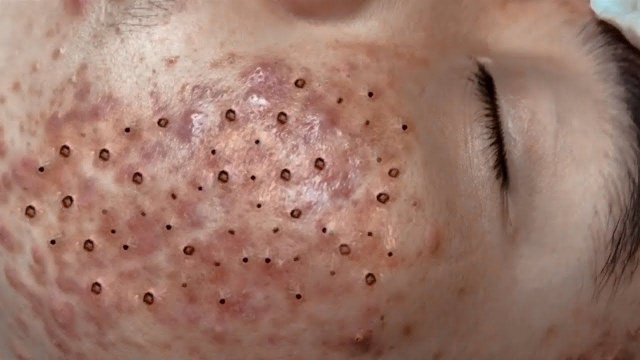 acne and blackhead removal #16 - YouTube