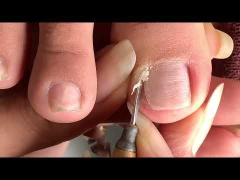 Clean the Skin and remove the corner of the nail#481