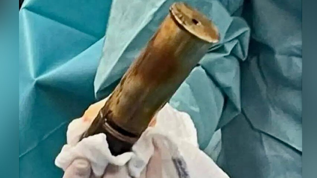 HOMBRE DE 88 AÑOS VA AL HOSPITAL CON UN PROYECTIL DE LA 1a GUERRA ...